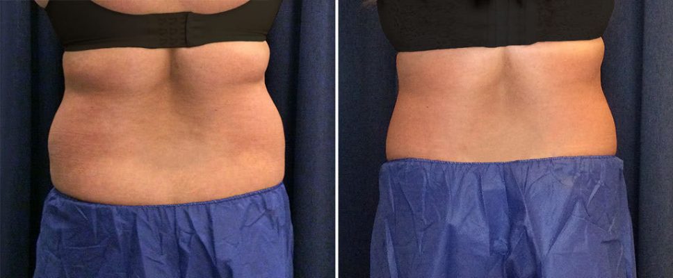Fort Worth CoolSculpting | Non-Surgical Fat Reduction | Kalos Medical Spa