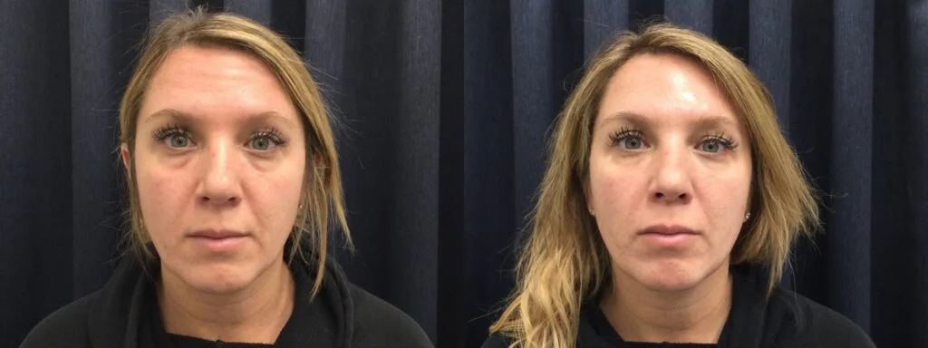 How to Avoid the Tyndall Effect and Get Beautiful Under-Eye Filler ...